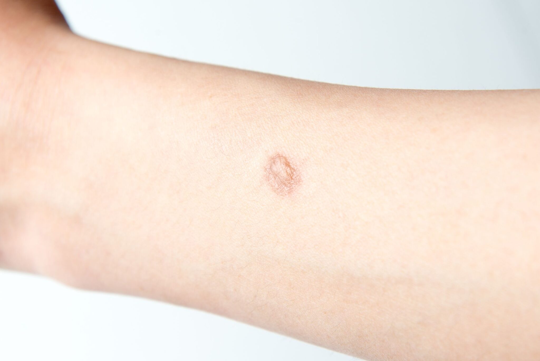 9 ways to get rid of boils ( Best and Fast )