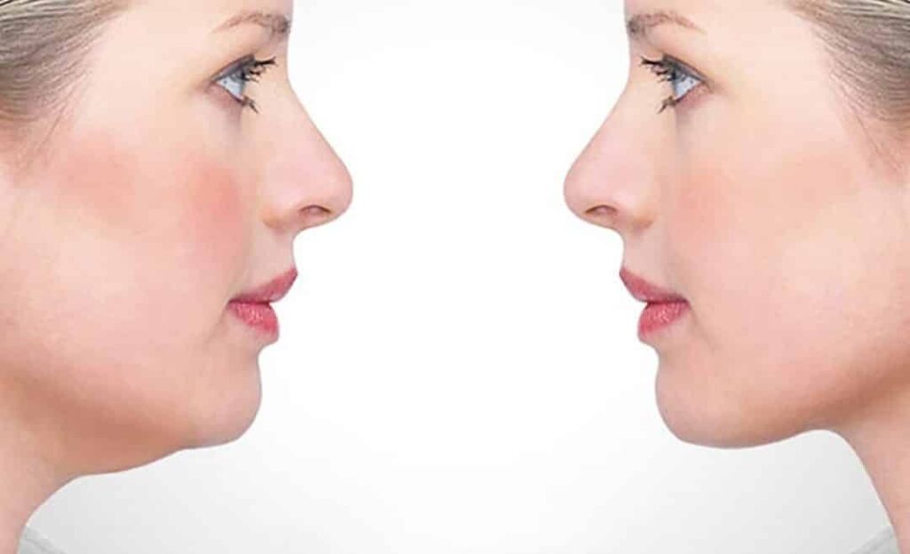 double chin mesotherapy: side effects, longevity and cost - SERENITY ...